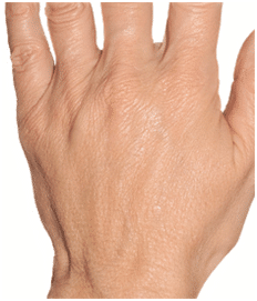 Ageing Hands Treatment | Solihull Medical Cosmetic Clinic